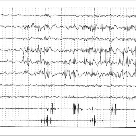 The Polygraphic Eeg Recording Shows Continuous Asymmetric And