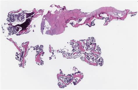 Hairy Cell Variant Leukemia