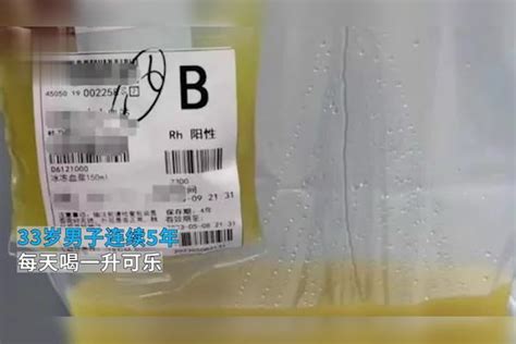 广西33岁男子连续5年，每天喝一升可乐，因急性重症胰腺炎住院可乐重症男子