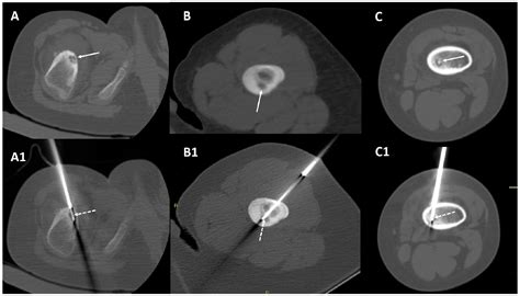Osteoid Osteoma Nidus