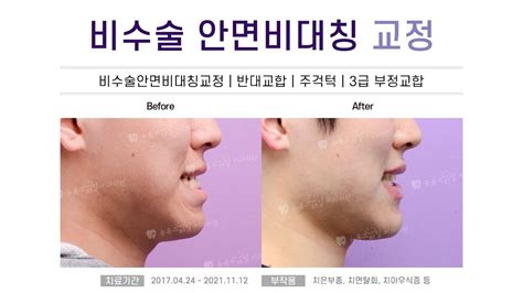 부산 안면비대칭교정 비수술 안면비대칭교정반대교합주걱턱3급부정교합 Beforeandafter 얼굴비대칭턱비대칭