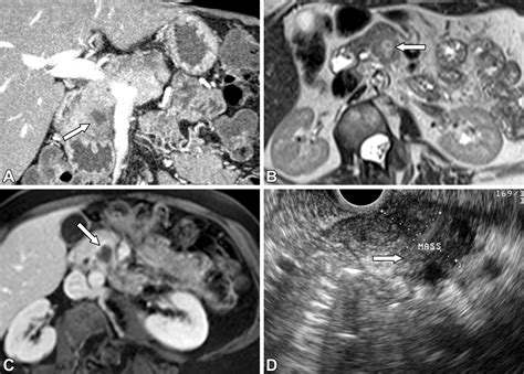 Pancreatic Cystic Lesions And Malignancy Assessment Guidelines And The Field Defect