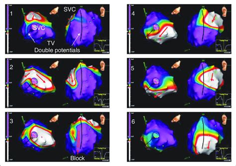 Non Contact Activation Map Of The Right Atrium During Counterclockwise Download Scientific