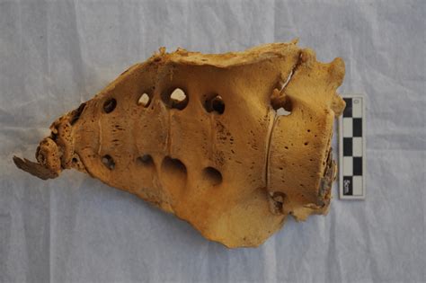 Has Anyone Seen Complete Or Partial Sacralization Of A Sixth Lumbar Vertebra