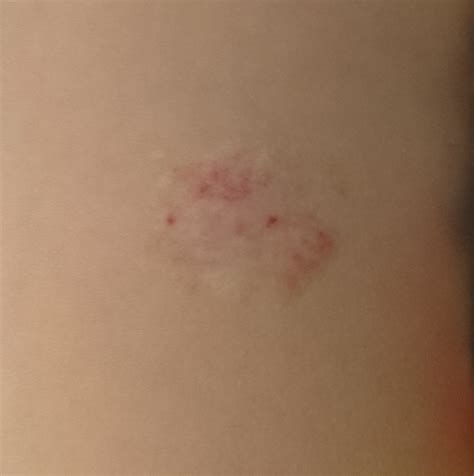 【苺状血管腫】治療への道 その⑦ 第3回レーザー治療 30代～妊活・出産・育児ブログ〜