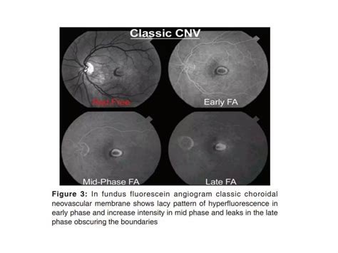Age Related Macular Degeneration Pptx