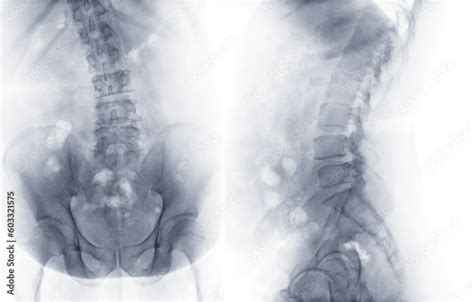 X Ray Image Of Lumbar Spine Or L S Spine Ap And Lateral View For