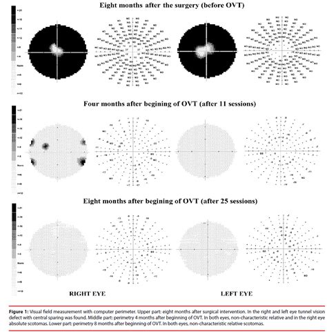 Visual Therapy In Open Space Rehabilitation Of Acquired Visual Field Defect