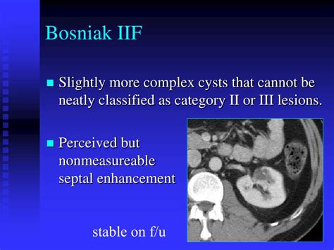 Ppt Imaging Of Small Renal Masses Powerpoint Presentation Free