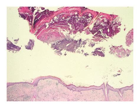 Excision Revealed A Variably Atrophic Epidermis With An Impressive
