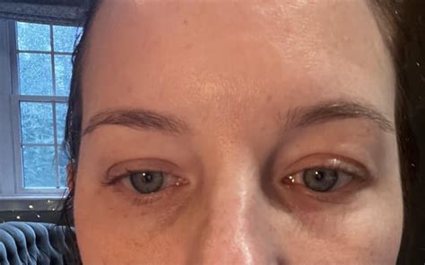 Upper Bleph R30plusskincare