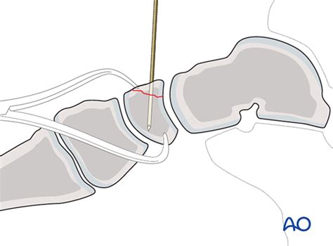 Lag Screw Fixation For Partial Articular Navicular Fracture