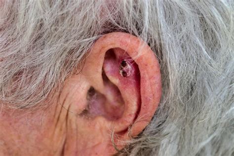 Nicotinamide To Help Reduce Basal Cell And Squamous Cell Carcinoma
