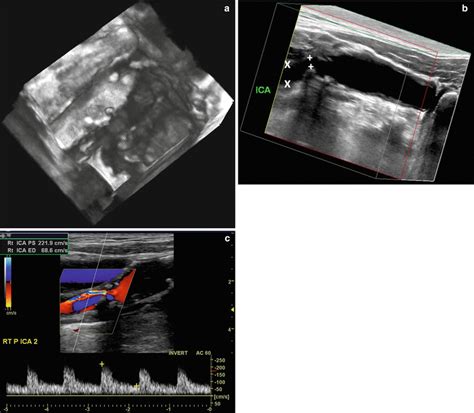 Three Dimensional Vascular Imaging And Power Doppler Angiographic