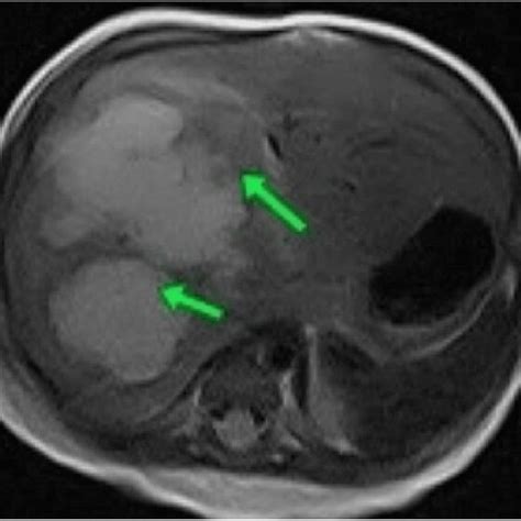 Magnetic Resonance Imaging Of The Abdomen Showing Hepatic Abscess The