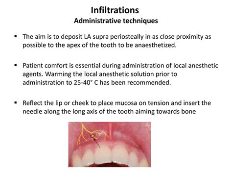 Dental Infiltration Anesthesia Technique On Youtube At Fred Morales Blog