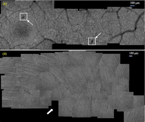 Figure 1 From Automatic Montaging Of Adaptive Optics Slo Retinal Images Based On Graph Theory