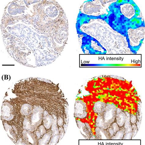 Representative Examples Of Tissue Microarray Cores With Low A And