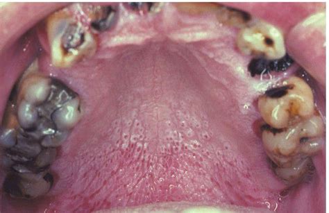 Nicotine Stomatitis Medizzy