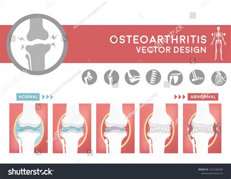 Progression Arthritis Photos Images And Pictures Shutterstock