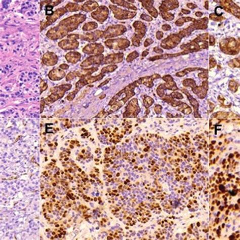 PDF GASTRIC NEUROENDOCRINE TUMOR REVIEW AND UPDATE