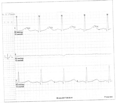 Prolongation Of The Qt Qtc Interval Of 500 560 Msec Download