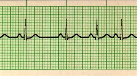 Ekg Detective Sinus Arrhythmia
