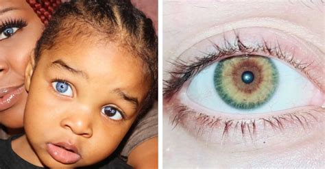 Complete Heterochromia Blue Green