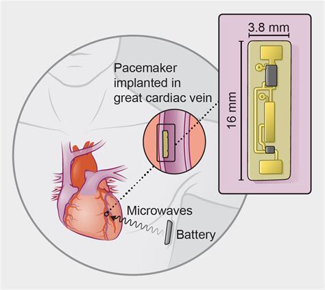 New Wireless Pacemaker Could Prevent Common Complications Scientific