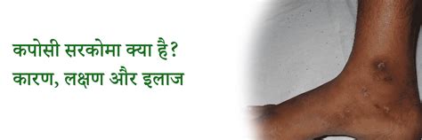 कपोसी सरकोमा क्या है कारण लक्षण और इलाज What Is Kaposi Sarcoma In Hindi
