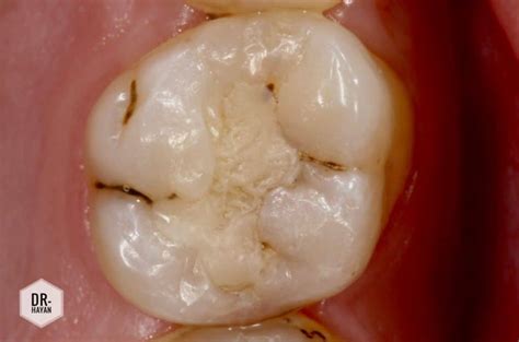 Quadrant Rehabilitation By Semi Direct Restoration Myzerodonto