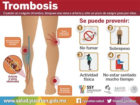 Salud Con Sentidos Trombosis Una Enfermedad Común Y Peligrosa