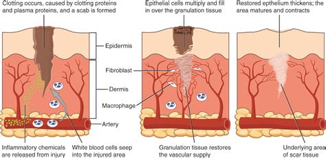 Granulation Tissue