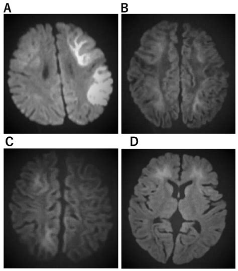 A Comprehensive Review Of Pediatric Acute Encephalopathy