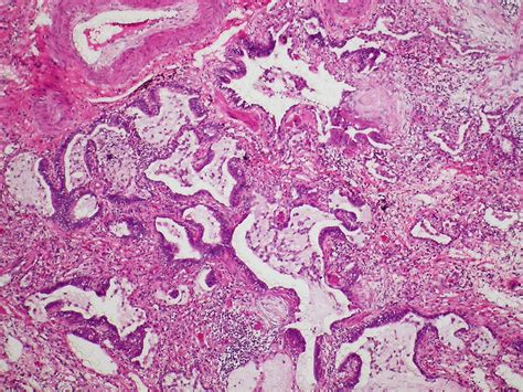 Scleroderma Case 291 The Most Frequent Pulmonary Lesions Flickr