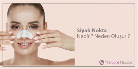 Siyah Nokta Nedir Neden Olu Ur Tedavi Y Ntemleri Nedir Uzm Dr Hande Ulusal