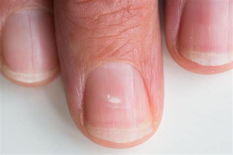 What Are The White Spots On My Fingernails Meaning At Marc Rogers Blog
