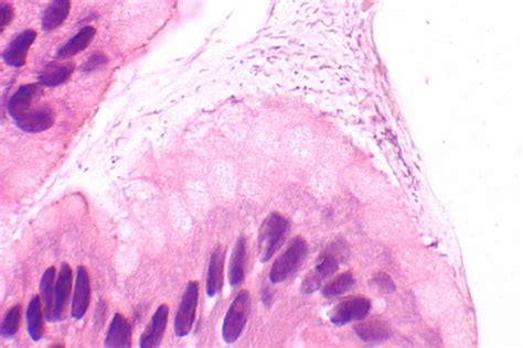 Helicobacter Gastritis Libre Pathology