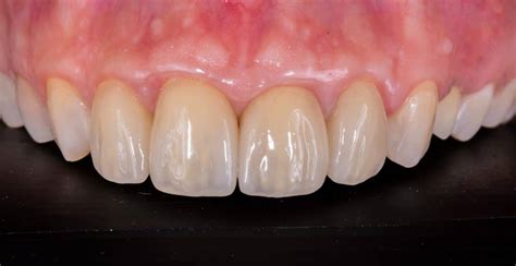 To Splint Or Not To Splint When Brain Gears Work More Than Neurotransmitters Myzerodonto