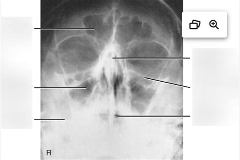Sinuses Parietoacanthial Projection Waters Diagram Quizlet