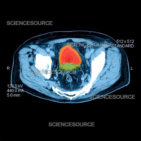 Photograph Ct Of Prostate Cancer Science Source Images