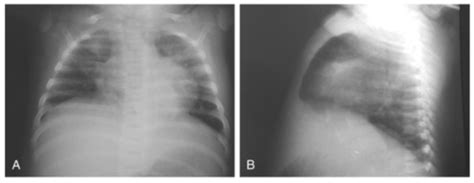 Ped Pulm Sec 2 Cont Infection Lung Disease Viral Infecions Flashcards Quizlet