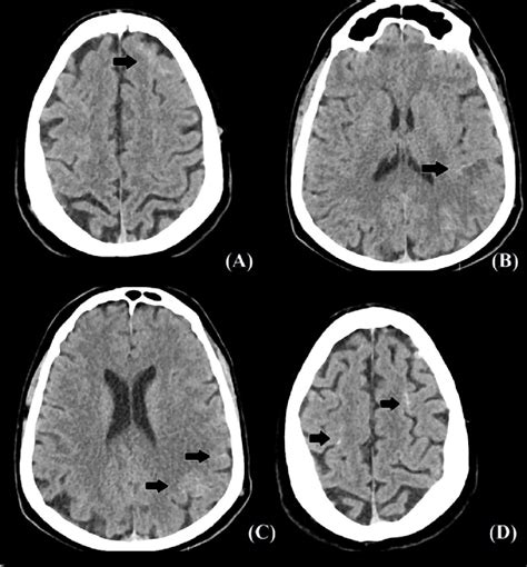 Ct Scan Axial Cross Sections Of The Brain A C Darrows Pointing To