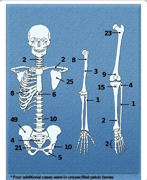 Anatomical Distribution Of Secondary Peripheral Chondrosarcomas
