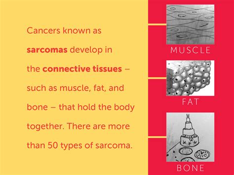 Signs And Symptoms Of Soft Tissue Sarcomas Dana Farber Cancer Institute