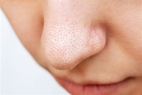 鼻の毛穴のボコボコを自力で治すには？目立つ原因と皮膚科での治療方法も解説 ハダメディア By Bihadadotokyo