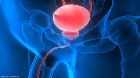 Management Of Bcg Unresponsive Nmibc