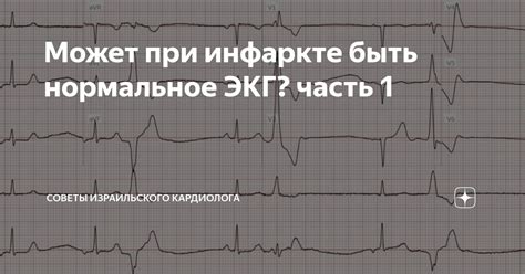 Может при инфаркте быть нормальное ЭКГ часть 1 Советы израильского