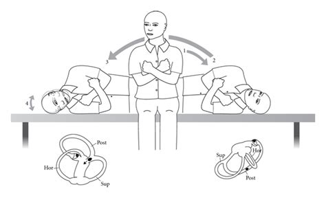 Epley Maneuver Instructions How To Do The Epley Maneuver At 60 OFF