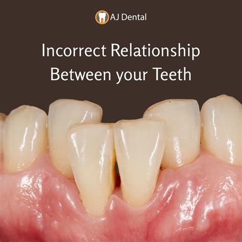 Aj Dental An Incorrect Relationship Between Your Teeth Known As Malocclusion Can Cause